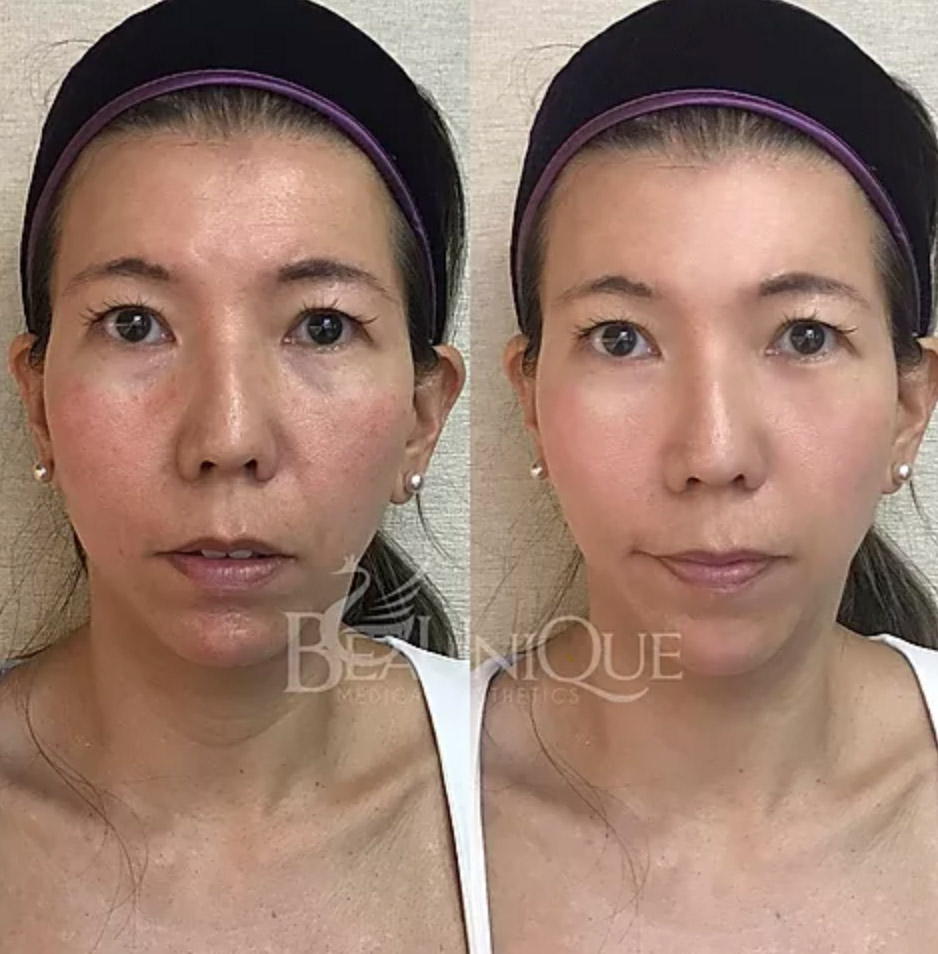 【第五代Thermage FLX價錢陷阱】三大招數驗證Thermage效果