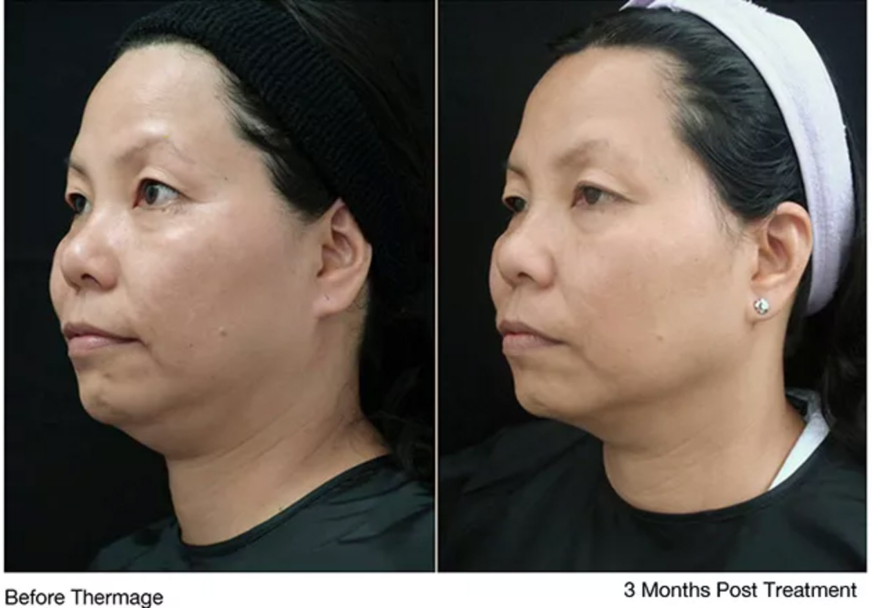 【第五代Thermage FLX價錢陷阱】三大招數驗證Thermage效果
