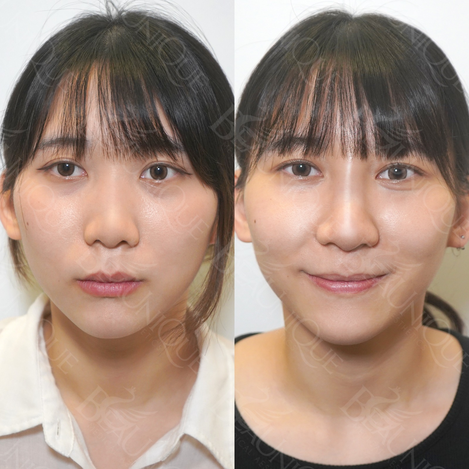 鼻雕專家 | Beaunique Medical Aesthetics