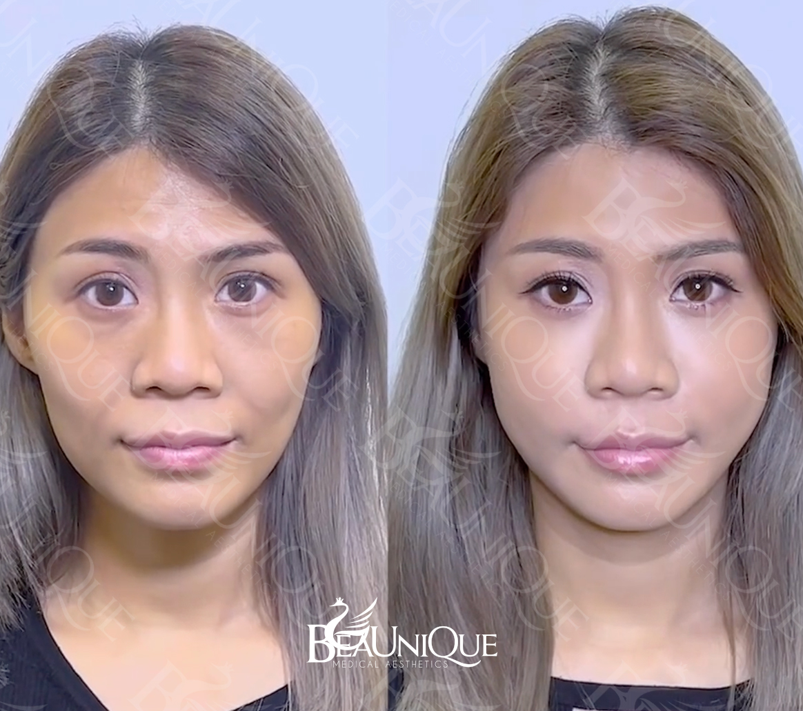 哈佛輪廓療程 | Beaunique Medical Aesthetics