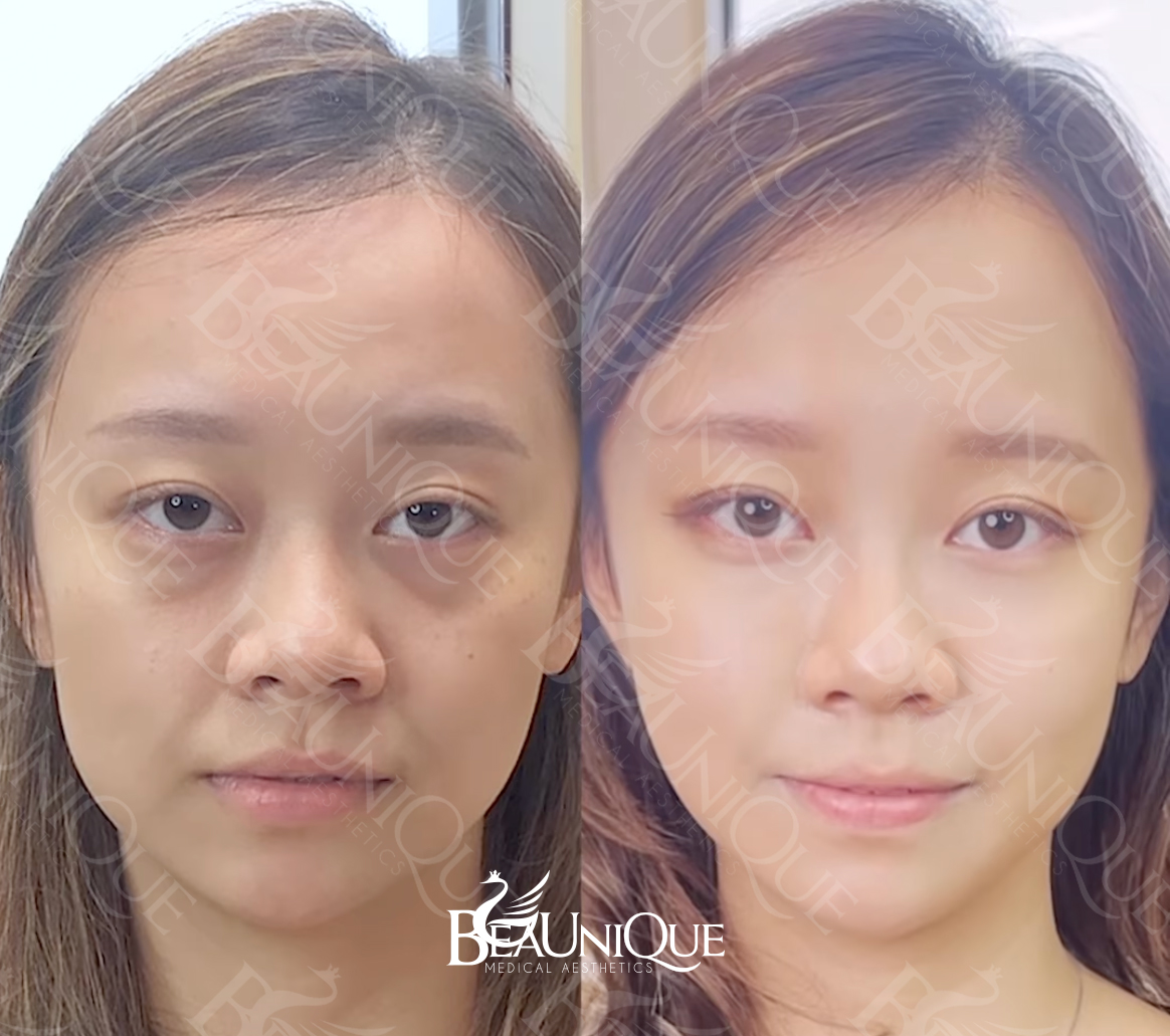 哈佛輪廓療程 | Beaunique Medical Aesthetics