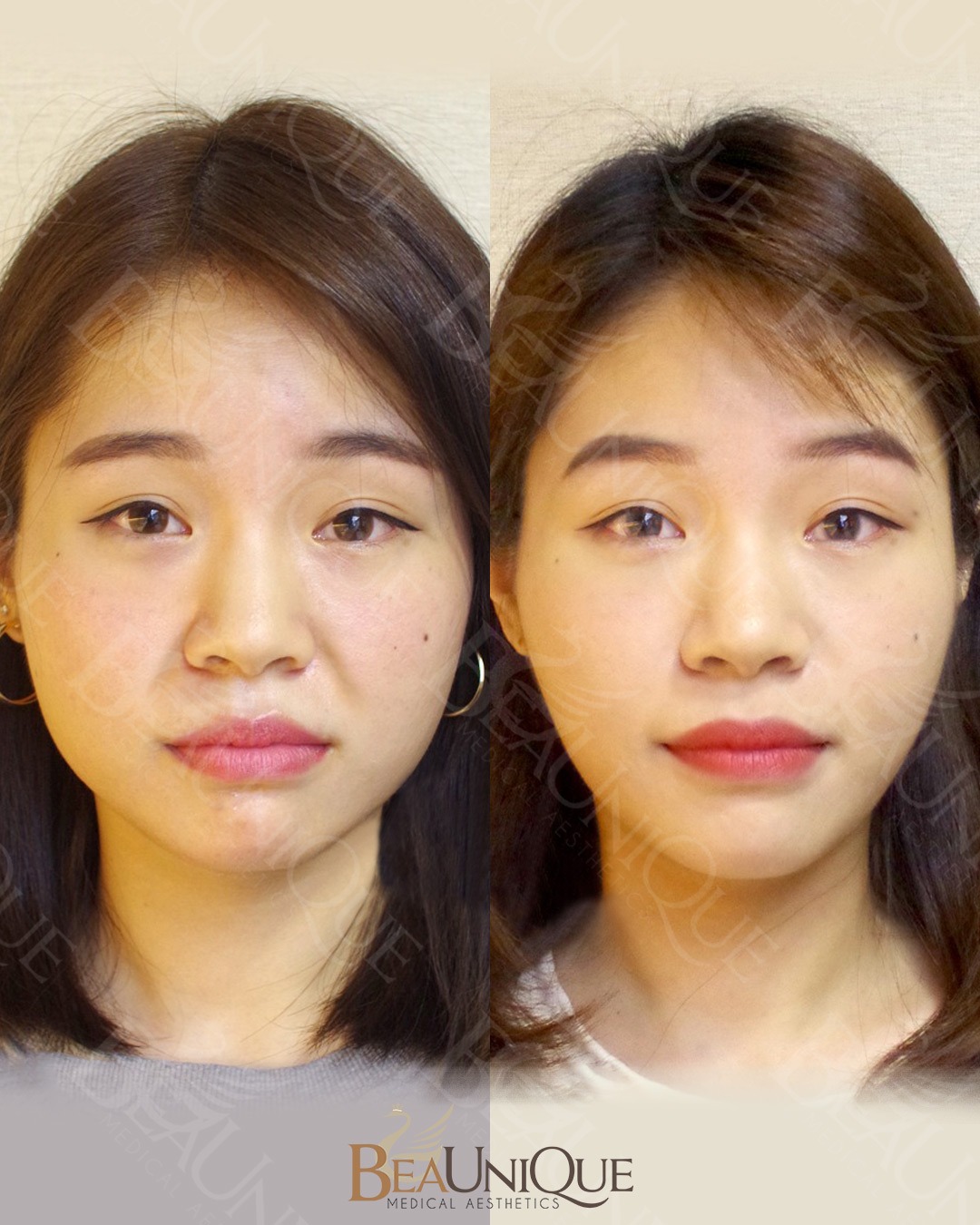 哈佛輪廓療程 | Beaunique Medical Aesthetics