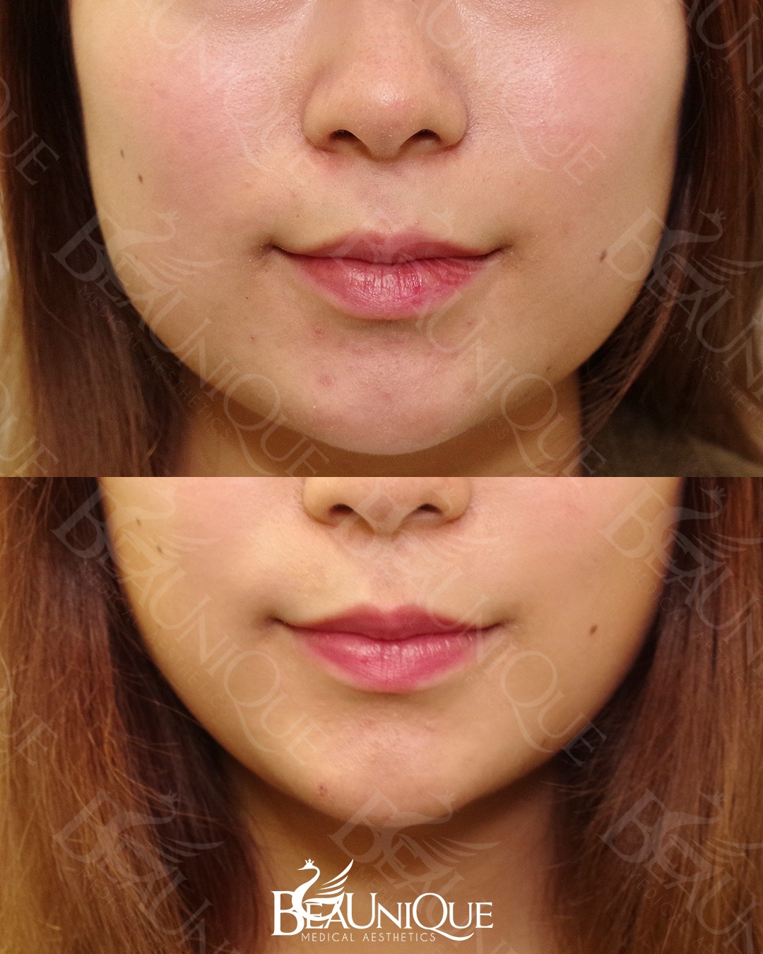 哈佛輪廓療程 | Beaunique Medical Aesthetics